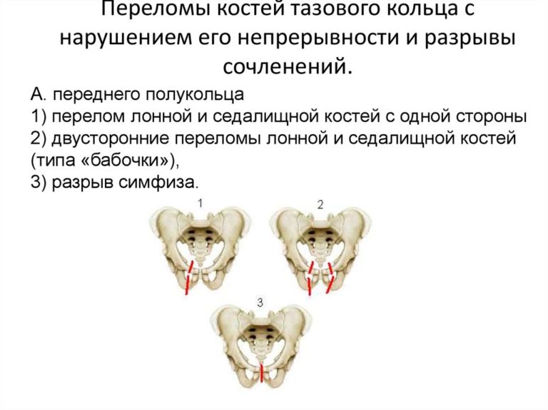 Перелом лонной кости таза без смещения: виды, лечение, последствия и ...