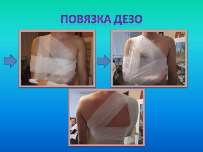 Повязка Дезо на плечевой сустав: алгоритм и техника наложения для женщин